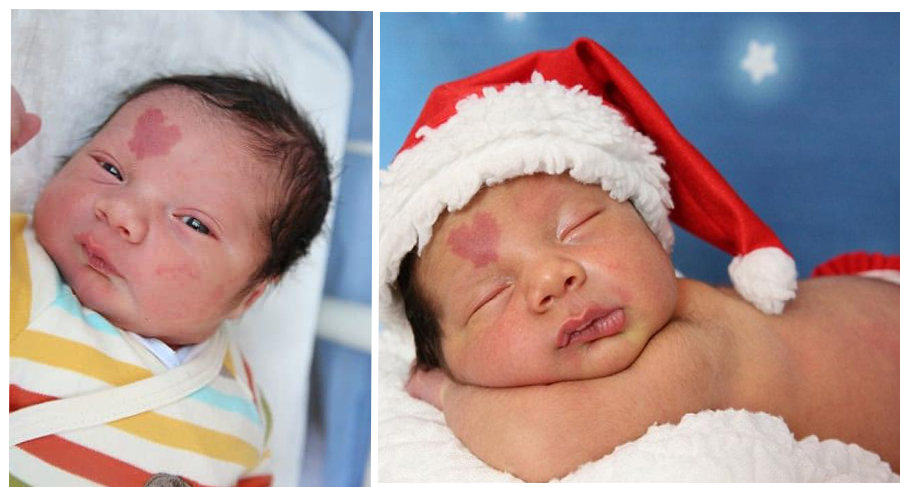 Il vient au monde avec une incroyable tâche de naissance en forme de ...