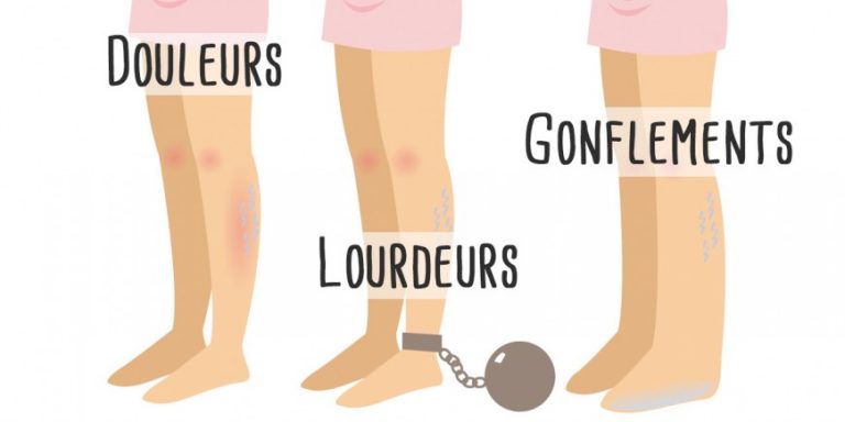 Phlébite, voici les 3 signes qui doivent vous alerter