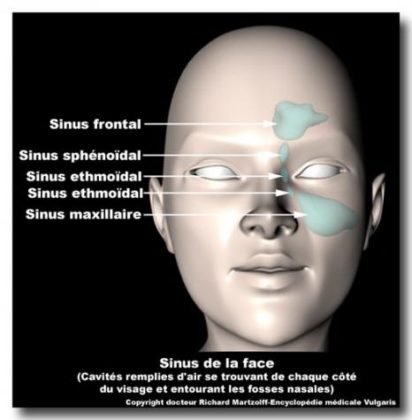 Sinusite Chronique : Causes, symptômes et traitements