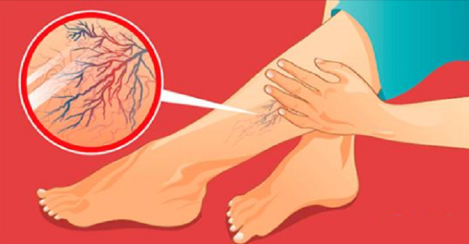 Varices des jambes : Symptômes, causes, traitement et prévention