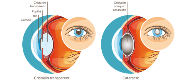 Cataracte : symptômes, causes, traitement et prévention