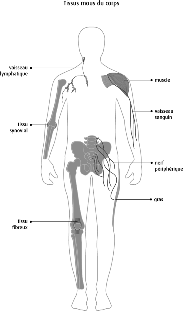Sarcome : différents types de sarcome, diagnostic et traitement