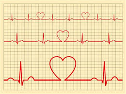 Arythmie : Un trouble cardiaque asymptomatique